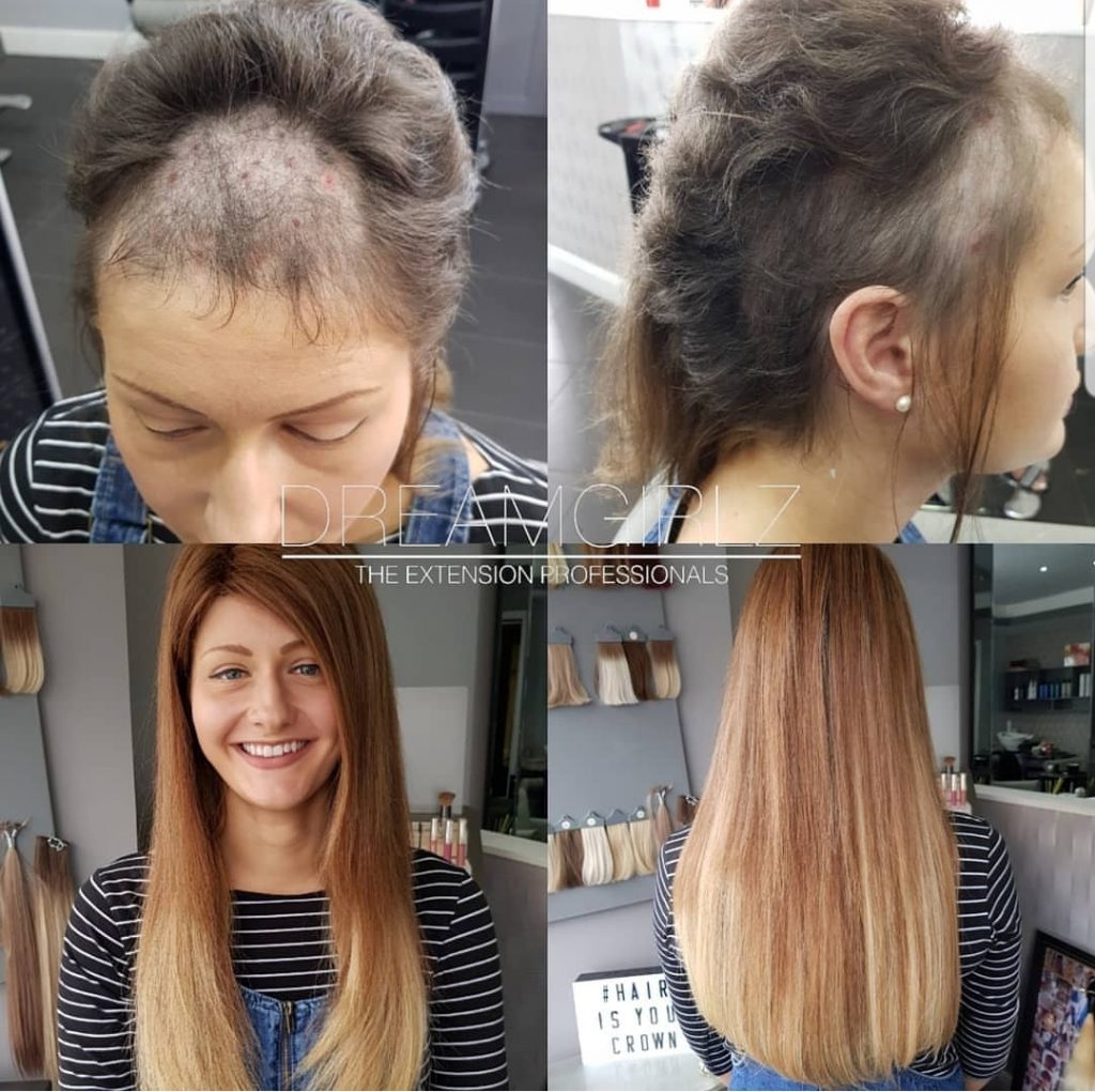 Hair Loss - Dreamgirlz Hair Extensions